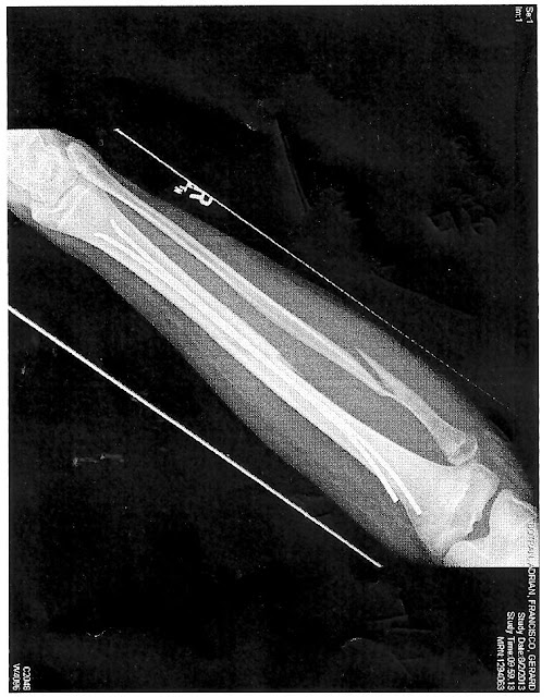 Inventor's Adventures: I broke my leg!