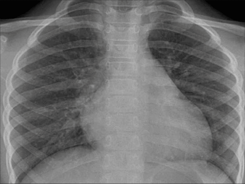MEDI LEARNER: ATRIAL SEPTAL DEFECT (ASD)