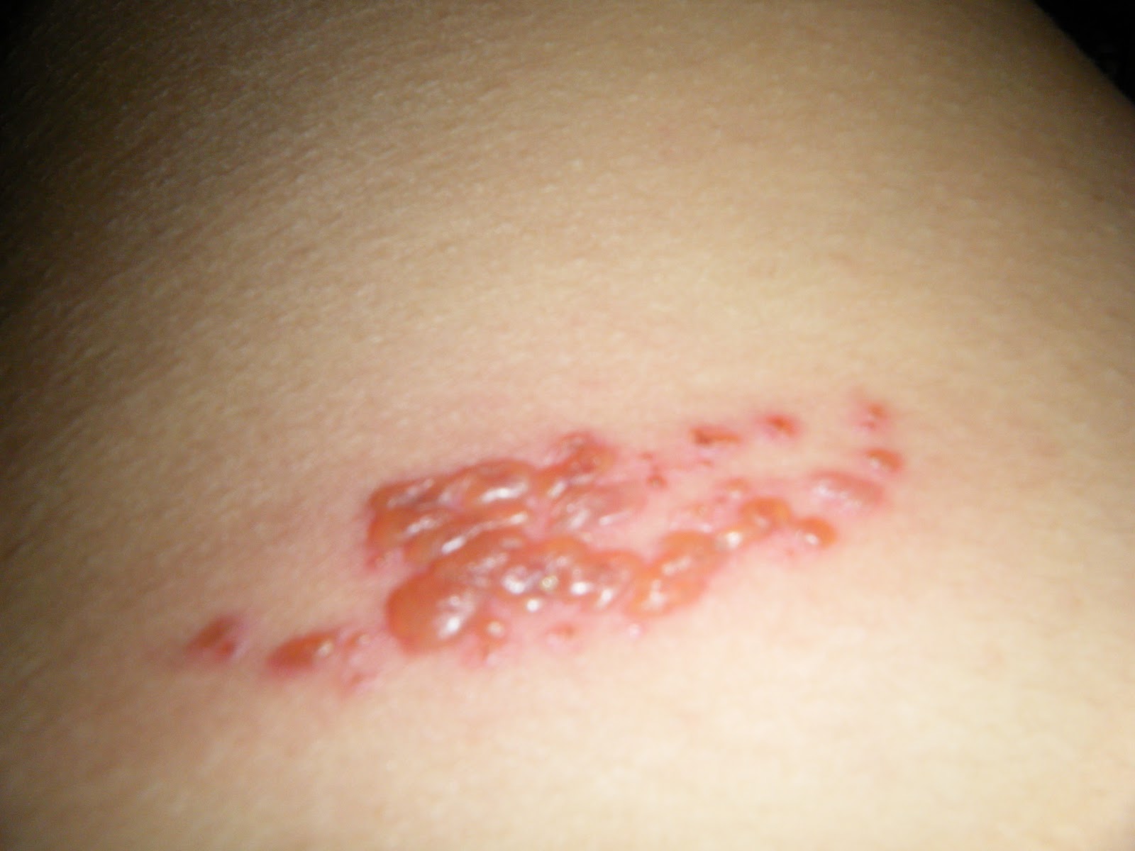 21 and Shingles: DAY 9: blisters SLOWLY oozing