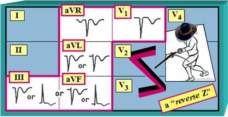ECG Interpretation: ECG Interpretation Review #47 (Normal Variants ...