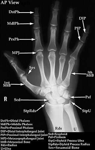 Radiographic positioning: Hand PA