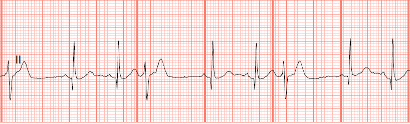 Basic EKG Rhythm Test 45