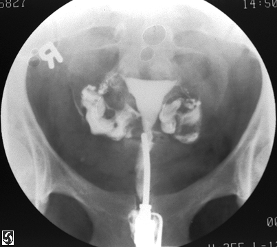 Aku Mahu Hamil...: All About HSG (Hysterosalpingogram)