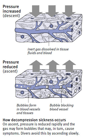 Decompression sickness ~ Nursing