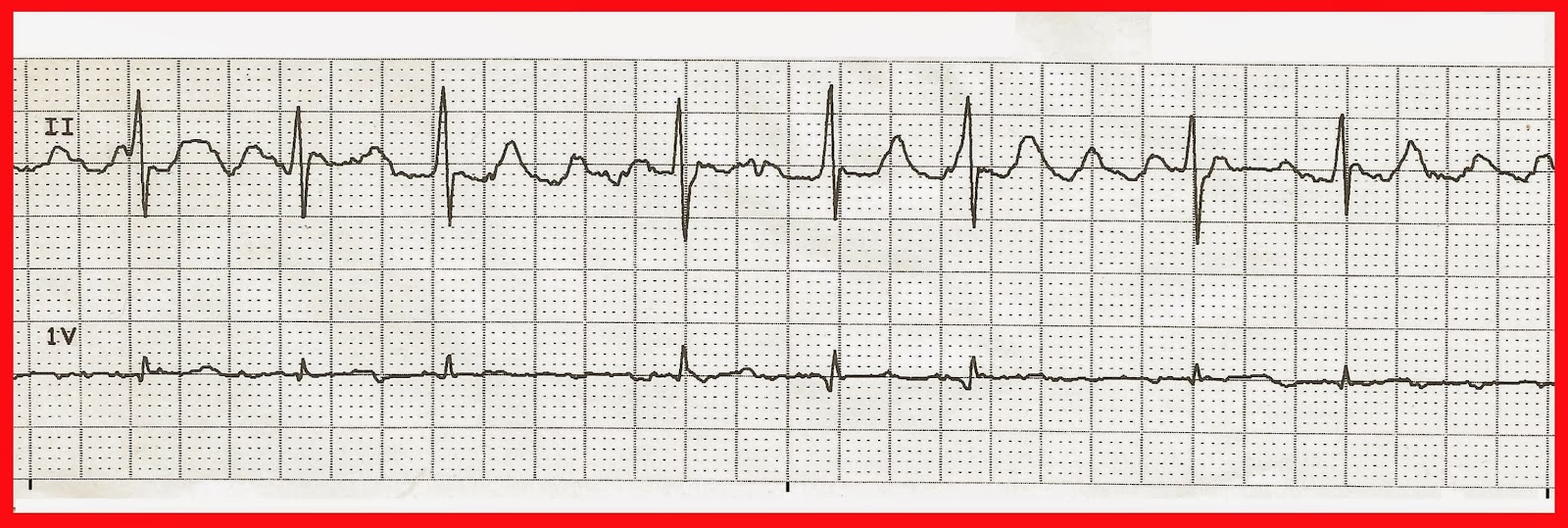 EKG Rhythm Strip Quiz 190