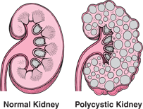 treatment for kidney disease: Cure for Bubbles in Polycystic Kidney Disease