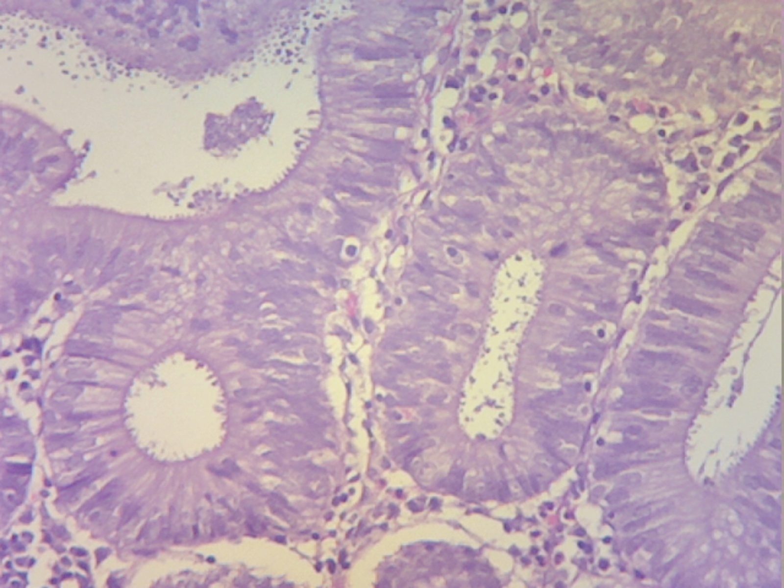 CUCI con displasia. | Consultoria en Anatomía Patológica y Medicina