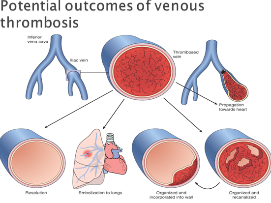 MBBS Medicine (Humanity First): Thrombosis