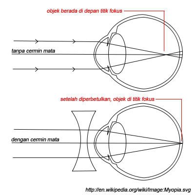 3 Cara Berkesan Rawat Mata Rabun Jauh (Miopia) | Pusat Rawatan Rabun Mata