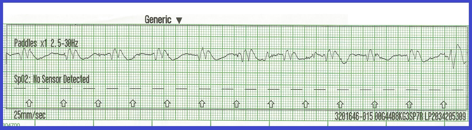 Code Blue: Sudden Cardiac Arrest
