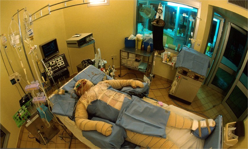 Coronel Von Rohaut: Grandes quemados