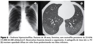 Síndromes&Enfermedades: Síndrome de Loeffler