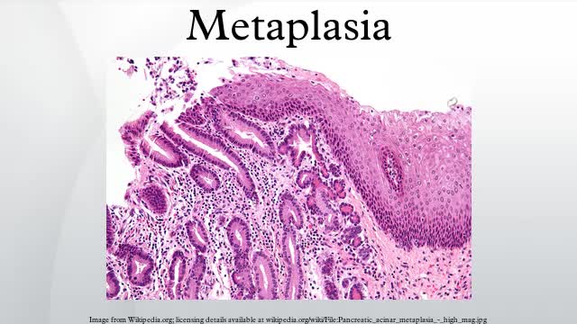 EXAMS AND ME : Metaplasia