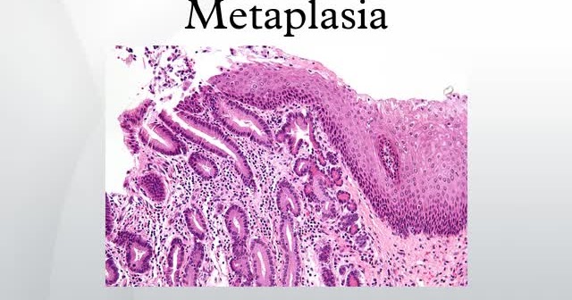 EXAMS AND ME : Metaplasia