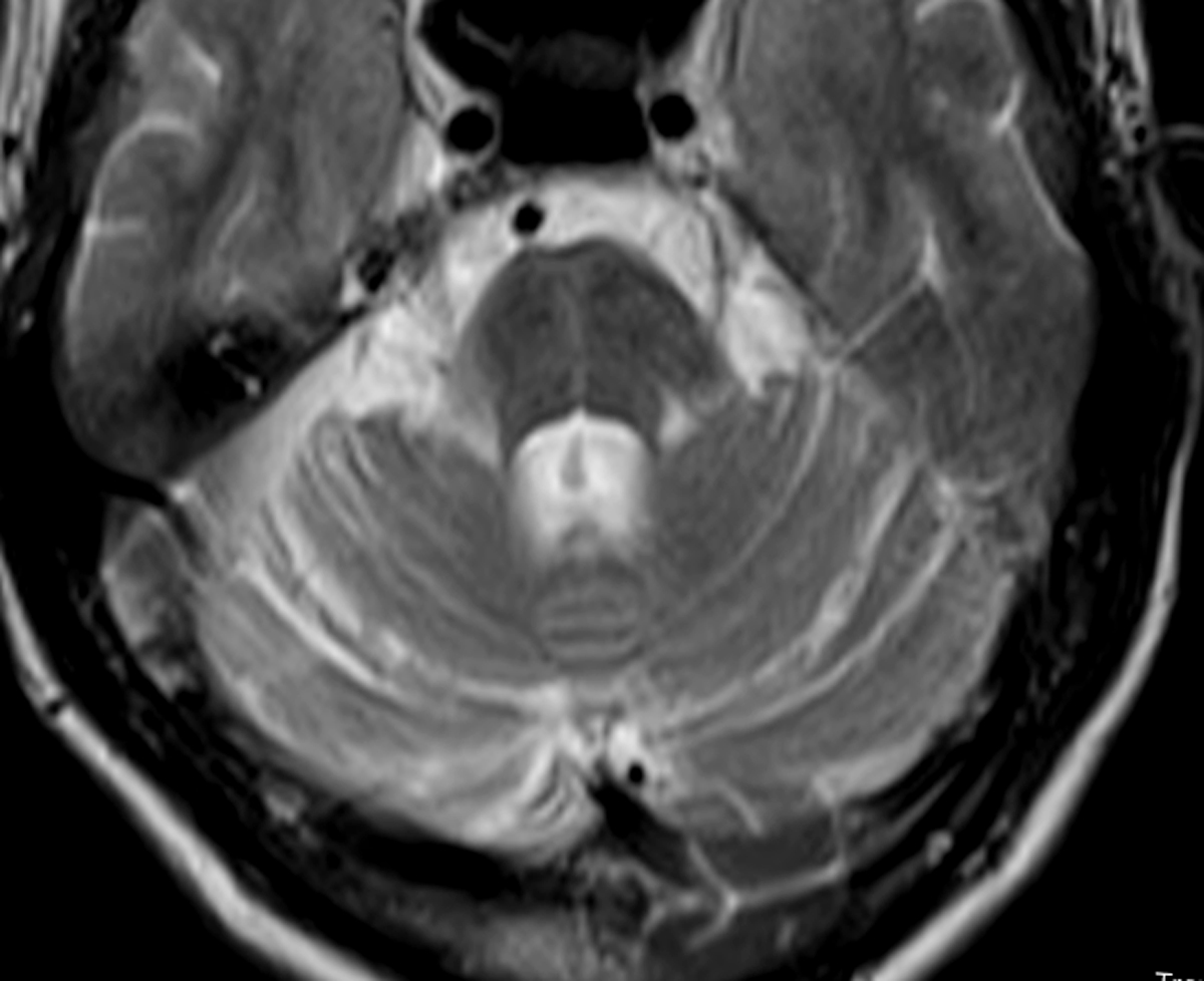 Radiodiagnosis - Imaging is Amazing-Interesting cases: Hot cross bun ...
