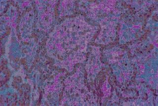 Fases de la Neumonía