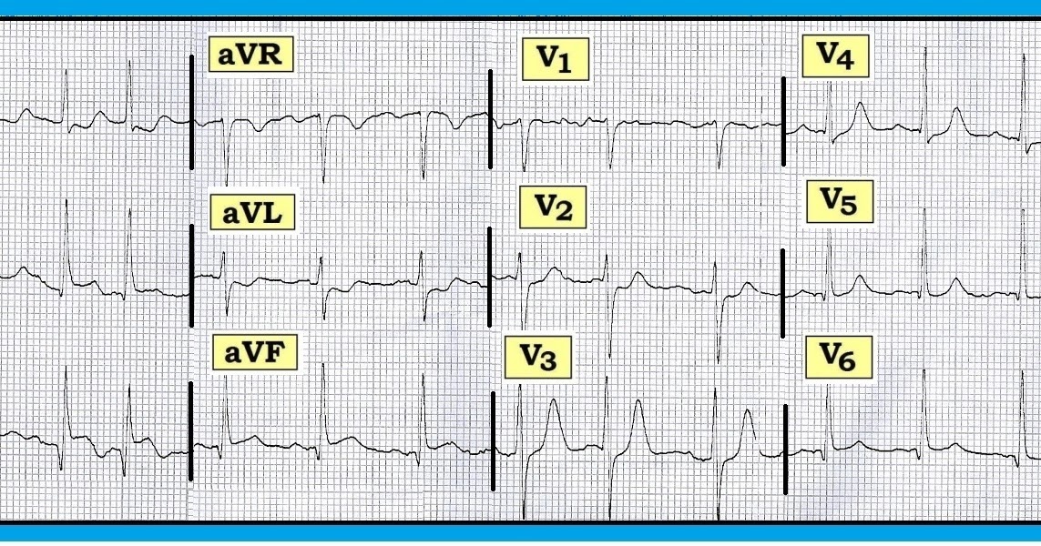 ECG Interpretation: ECG Interpretation Review #43 (AFib - PACs - Acute ...