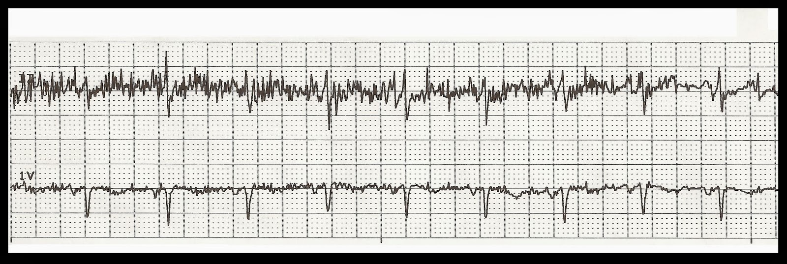 Practice EKG Rhythm Strips 231