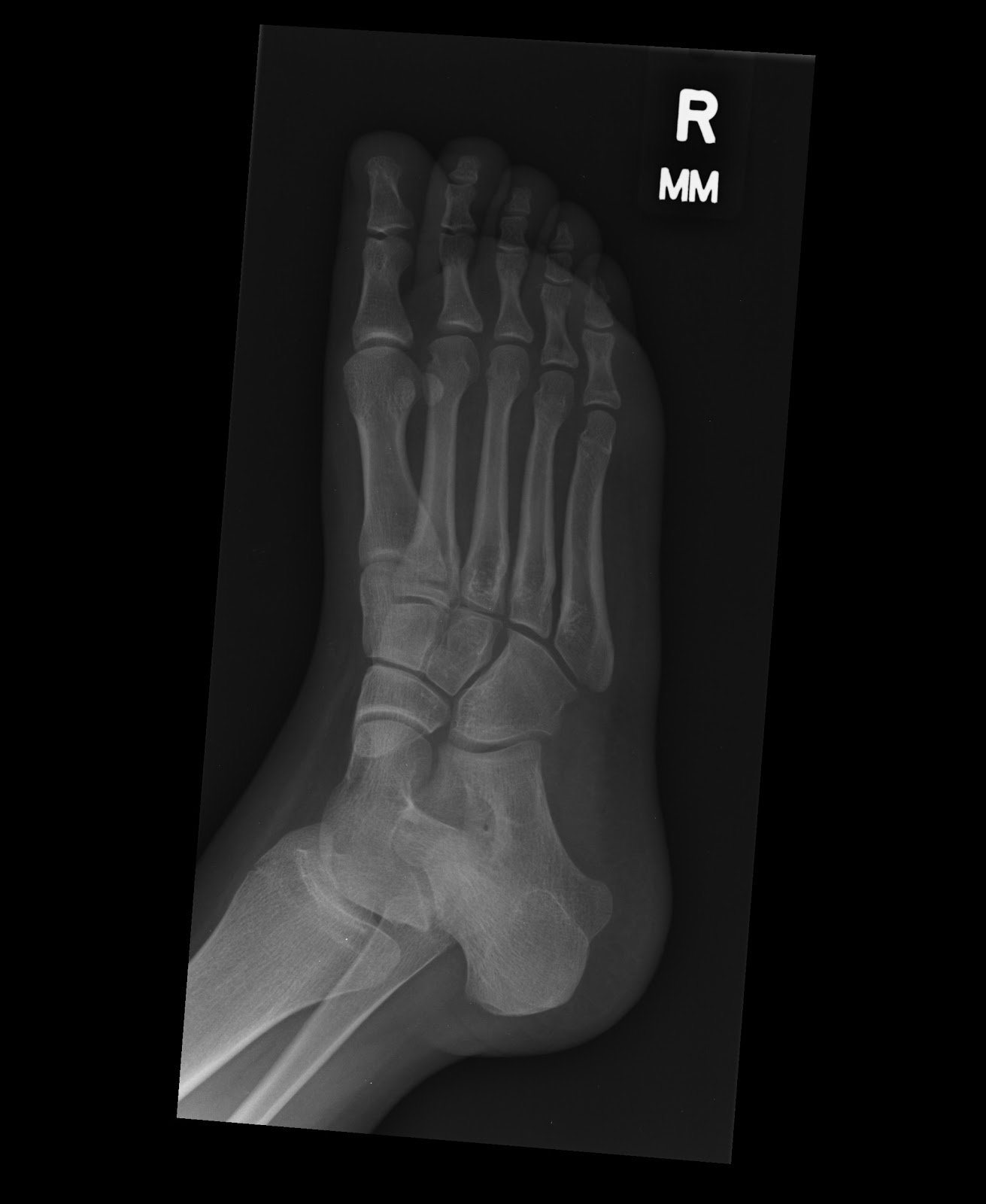 Daily Dose: cuboid fracture
