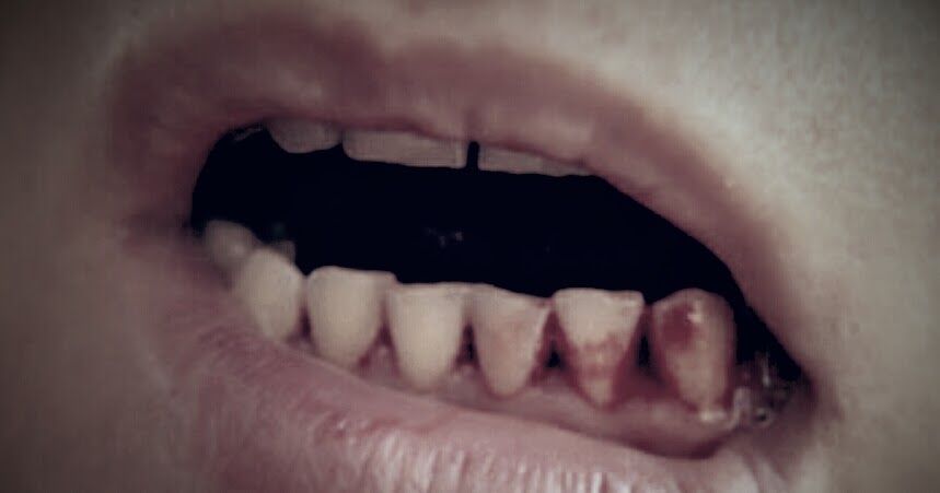 Gingivitis (Radang Gusi) : Pengertian, Penyebab, Dan Pengobatannya