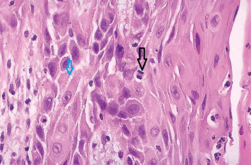 Histopatología: PATOLOGÍA GENERAL DE LAS NEOPLASIAS