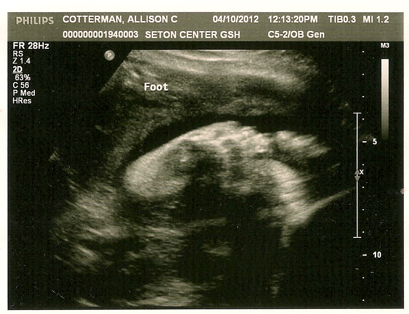 William Jude: 33 week ultrasound