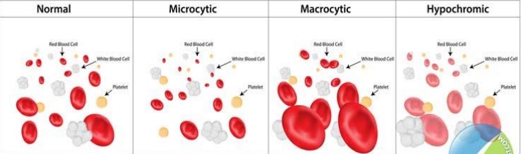 Anemi Nedir? Çeşitleri ve Sebepleri Nelerdir? Tedavisi Nasıl Yapılır?