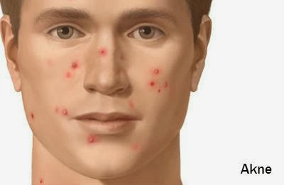 acne_400.jpg