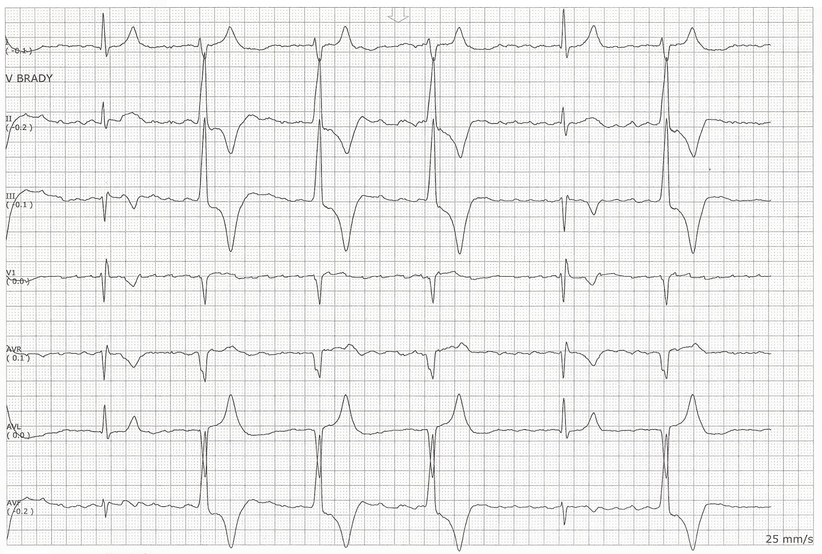Atrial Fibrillation with Ventricular Escape Beats