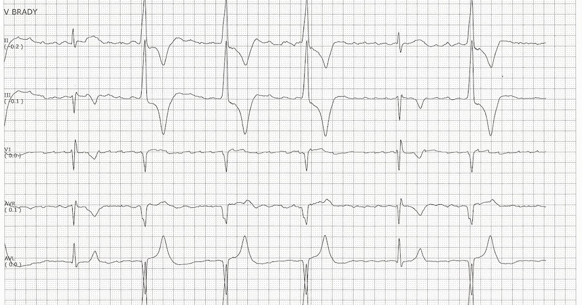 Atrial Fibrillation with Ventricular Escape Beats