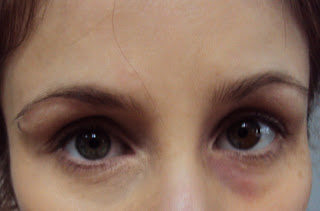 Allergic Shiners Important Things You Need to Know