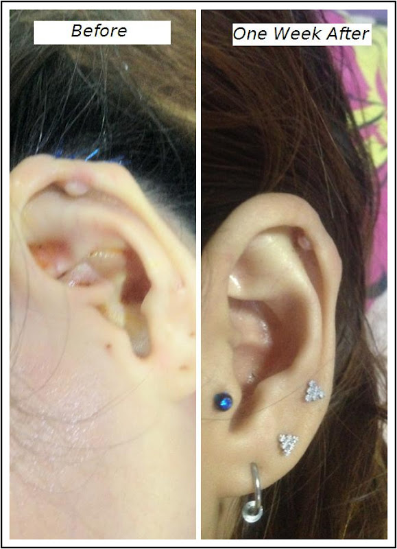 My Keloid Removal (Excision) Updates And Keloid Removal via Injection ...