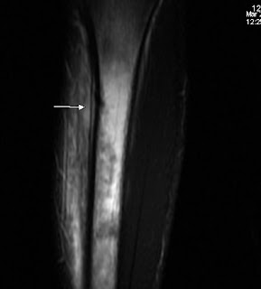 Tibial Stress Fracture-MRI - Sumer's Radiology Blog