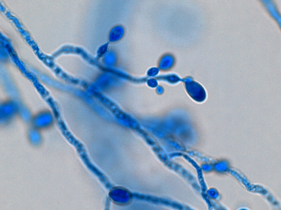 Fun With Microbiology (What's Buggin' You?): Scedosporium prolificans