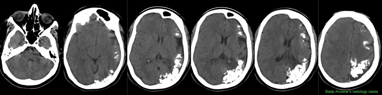 Dr Balaji Anvekar's Neuroradiology Cases: Intracranial calcifications