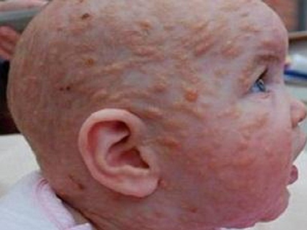 Erupcao Cutanea Eritematosa Difusa Exantema Maculopapular