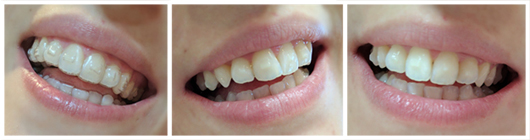 Blog de Invisalign, mi diario / experiencia: Alineador Nº 2 - Ataches ...