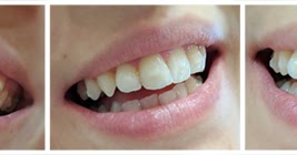 Blog de Invisalign, mi diario / experiencia: Alineador Nº 2 - Ataches ...