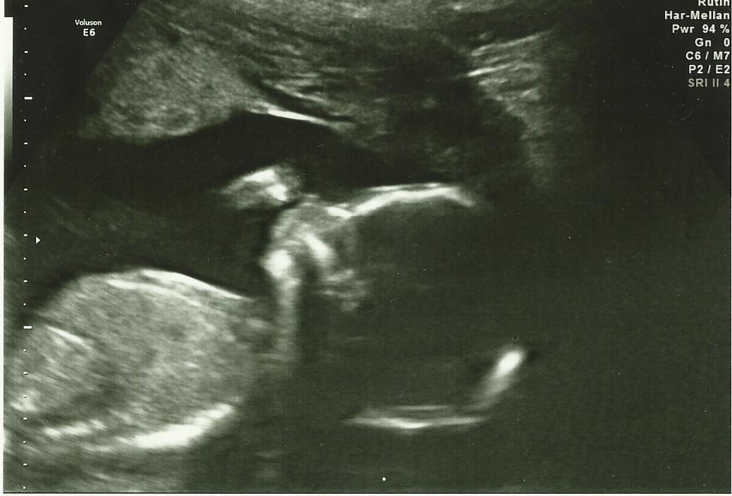 Små mirakel: Ultraljud