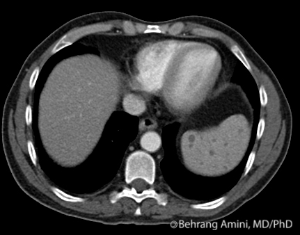 Roentgen Ray Reader: Spotted Spleen