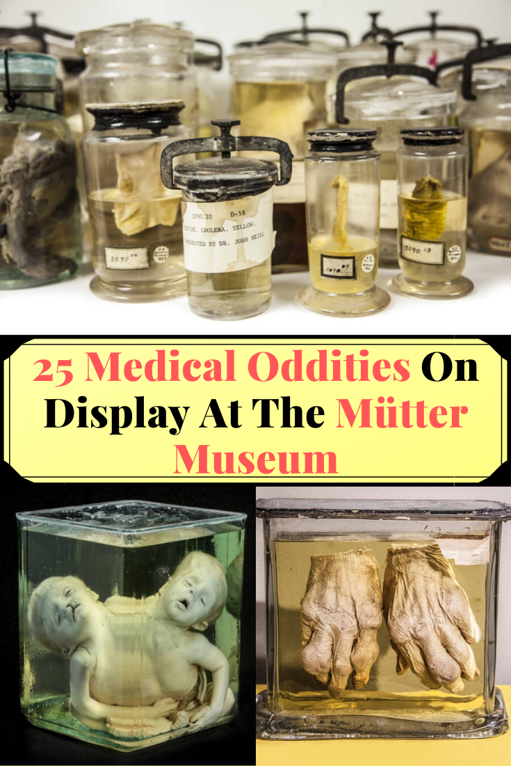 25 Medical Oddities On Display At The Mütter Museum