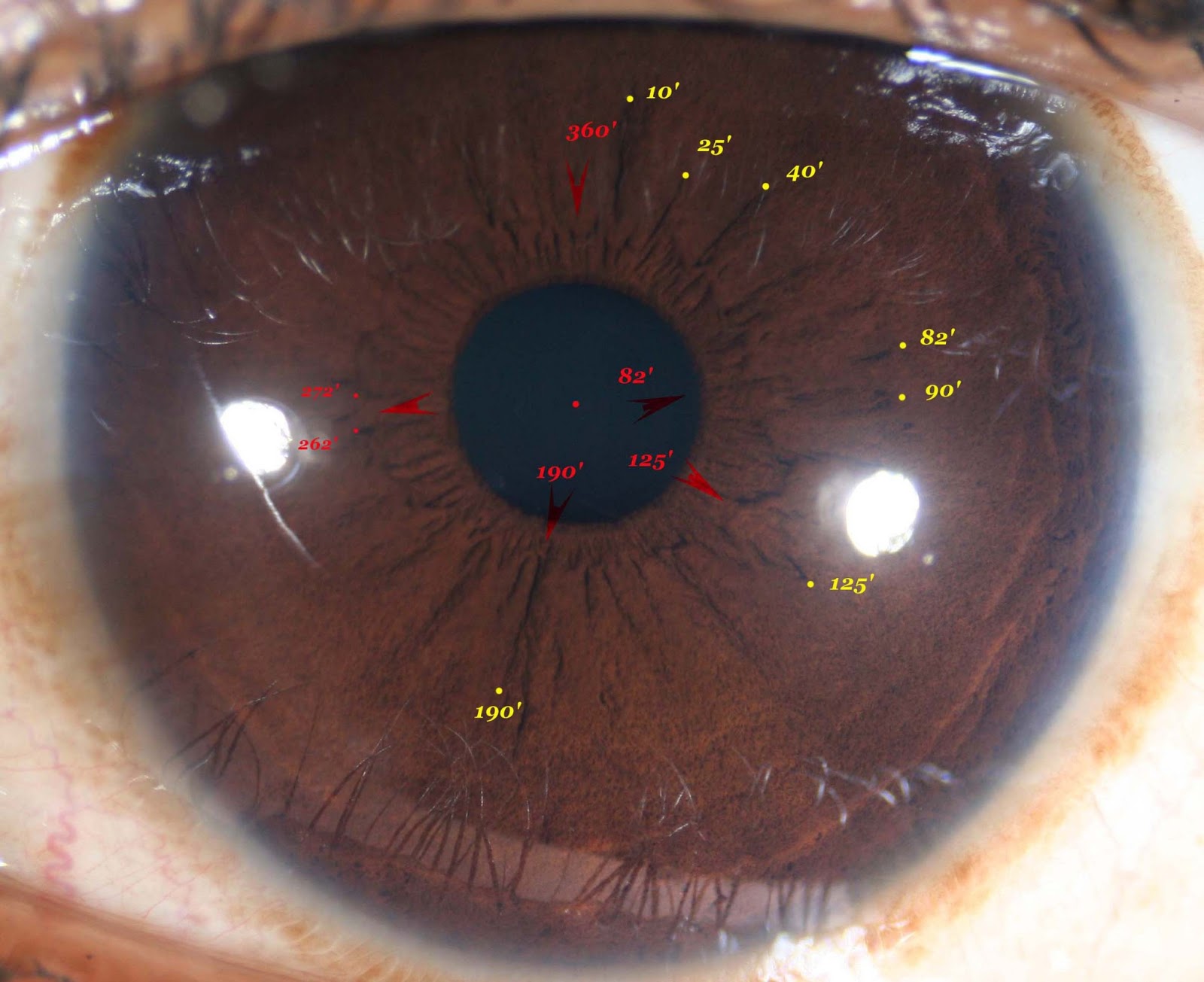 Modern & Multidimensional Iridology: The Integrity of the Collarette ...