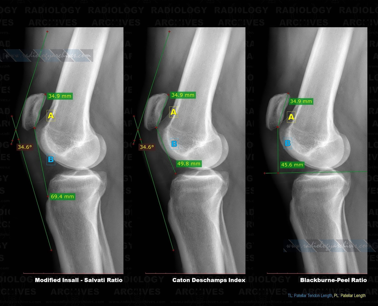 Radiology Archives: Υψηλή Επιγονατίδα (Insall - Salvati Ratio* > 1,5)