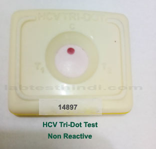 Hepatitis C ( HCV ) Test कैसे करते है ~ Lab Test Hindi