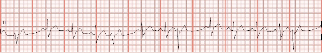 EKG Rhythm Strip Quiz 35