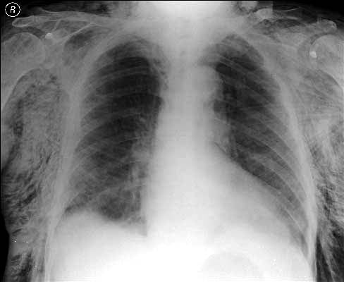 NURSEupdate: X-RAY SHOWING SURGICAL EMPHYSEMA