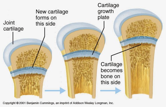 Treating Achondroplasia: Treating achondroplasia: the history of the ...
