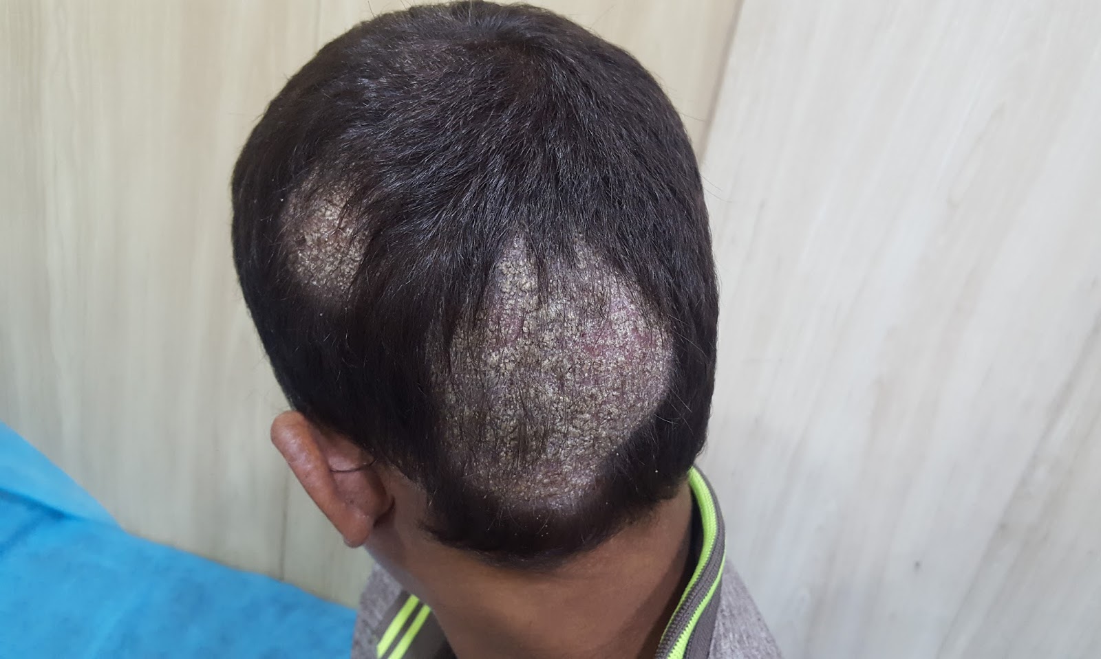 Dermatology Made Easy: Psoriasis-like Tinea capitis