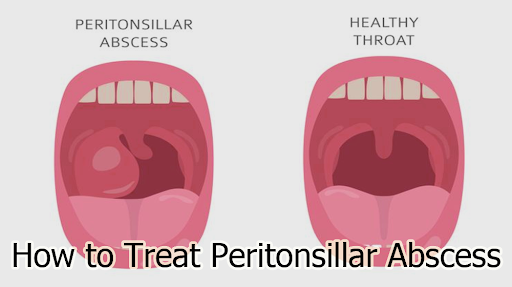 How to Treat Peritonsillar Abscess