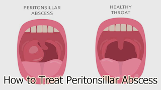 How to Treat Peritonsillar Abscess
